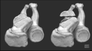 Why the Coronoid Process of Ulna is Important for Elbow Stability