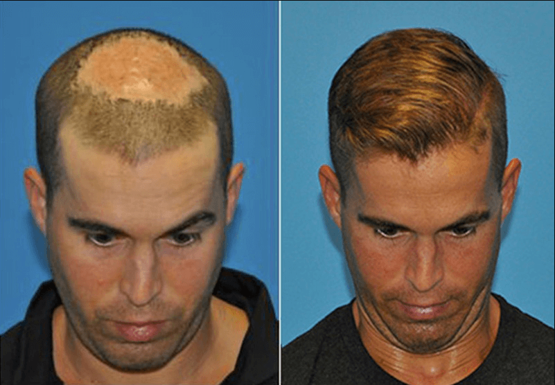 What You Need to Know About Hair Transplant Infection