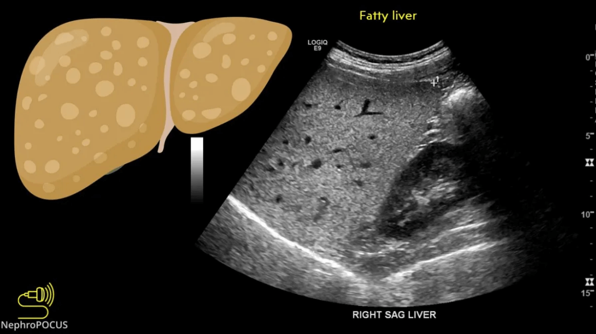 Echogenic Parenchyma: Exploring Causes, Symptoms, and Treatment Options