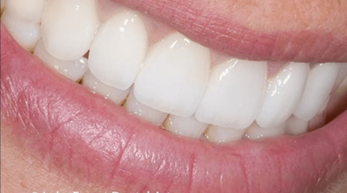 Dental Bridge Front Teeth Before and After Regaining Your Smile