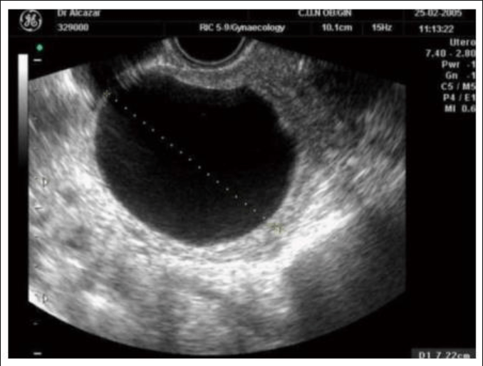 Ovarian Cyst Ultrasound Pictures: A Comprehensive Guide