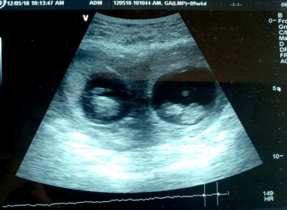 6 Week Ultrasound Twins: A Peek into Early Development
